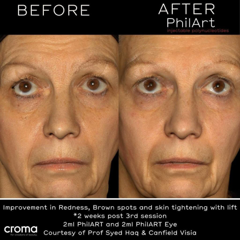 Reveal Mesmerizing Eyes: Experience PhilArt Eye Treatments at Our ...