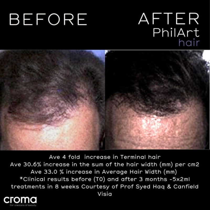 Discover Polynucleotides with PhilArt: Elevate Your Skin's Beauty at ...