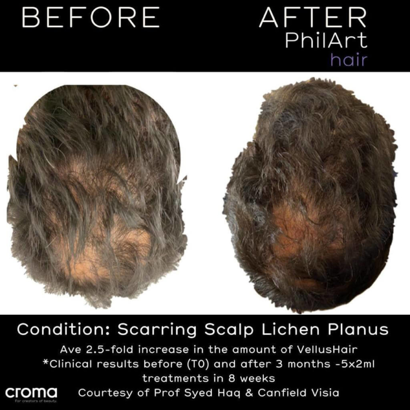 Discover Polynucleotides with PhilArt: Elevate Your Skin's Beauty at ...