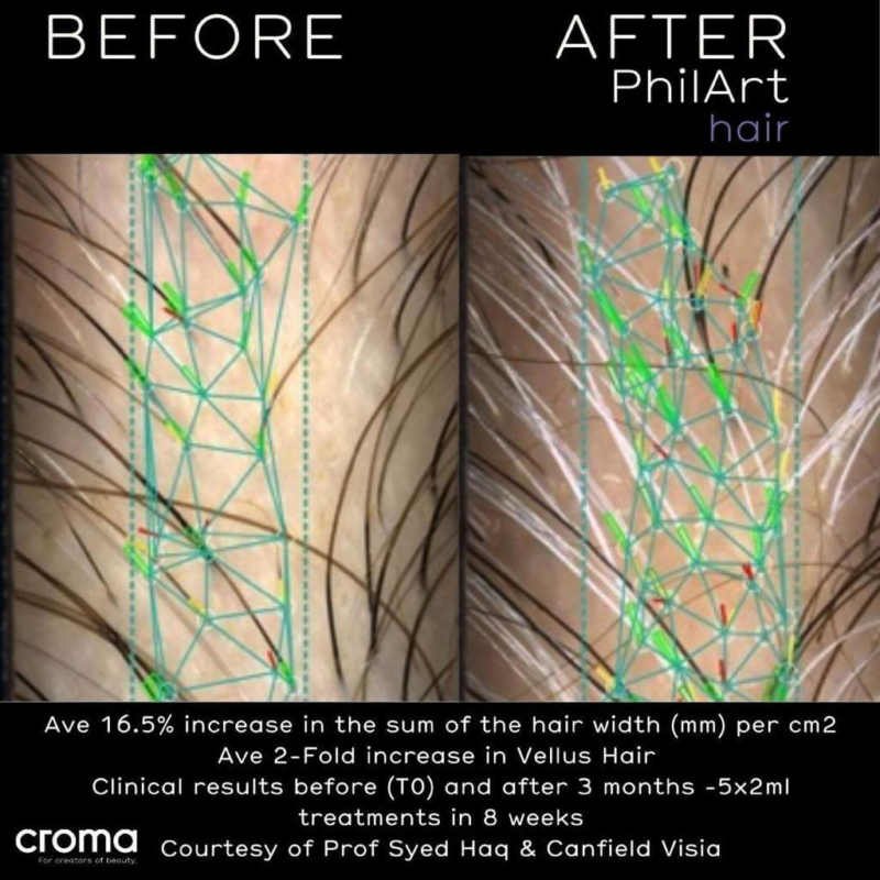 Discover Polynucleotides with PhilArt: Elevate Your Skin's Beauty at ...