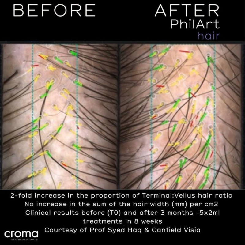 Discover Polynucleotides with PhilArt: Elevate Your Skin's Beauty at ...