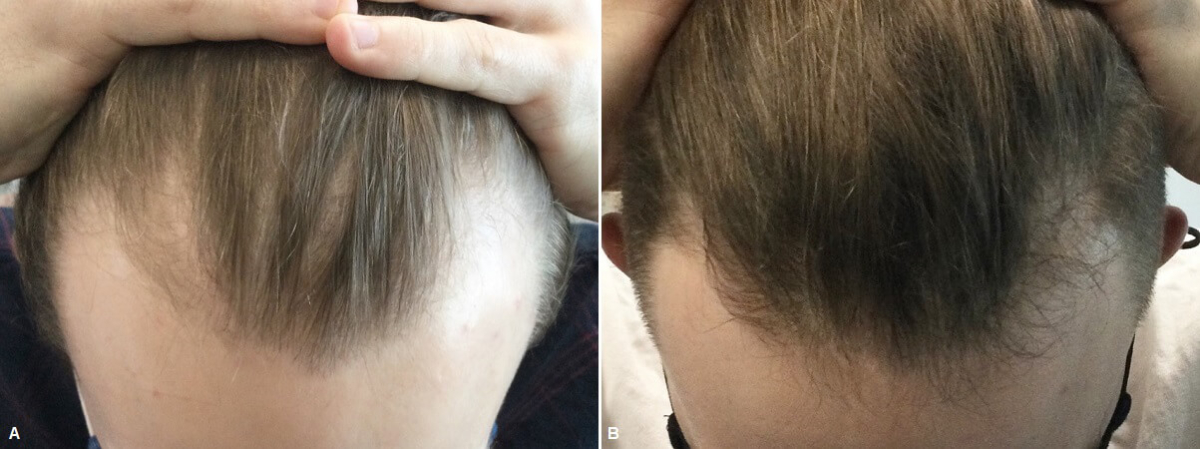 PRP Hair Loss Treatments in Hampton Hill | Stimulate Hair Growth Naturally